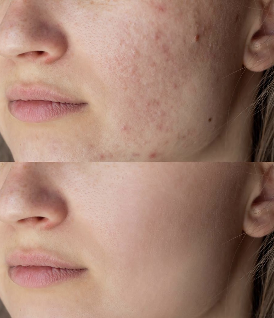Facial – Tratamiento de cicatrices y marcas por acné – Dra. Agustina ...